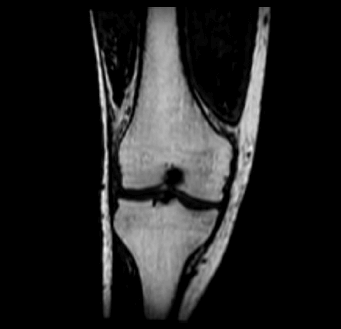 MRT Knie - Alles zur Kernspintomographie des Knies: Med 3