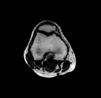 MRT Knie - Alles zur Kernspintomographie des Knies: Med 3